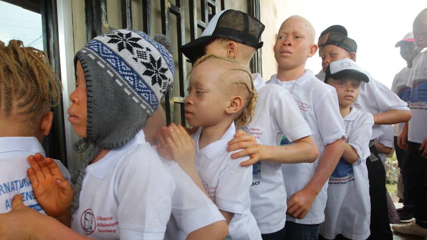 Vijf vooroordelen over albinisme ontkracht: 'We hebben geen rode ogen ...