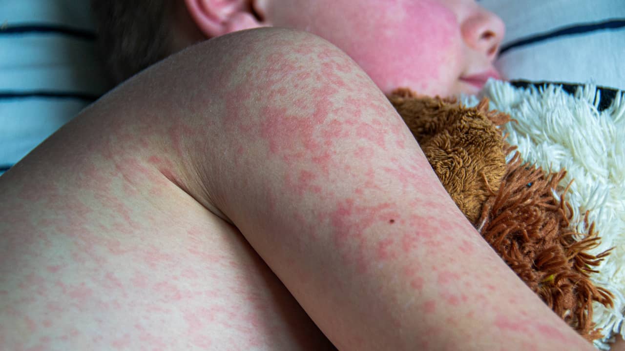 Mazelen verspreiden zich sneller: vijftig nieuwe gevallen in één week ...