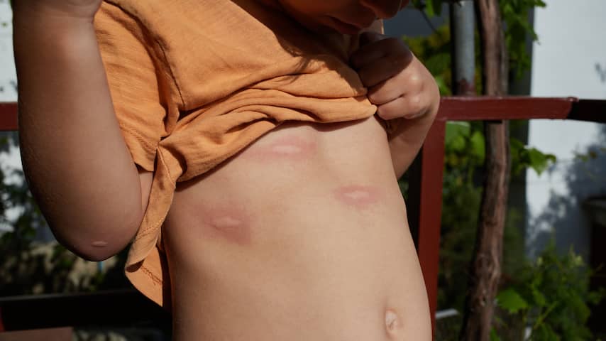 Hoe ga je een jeukende muggenbult te lijf? | Slimmer leven | NU.nl